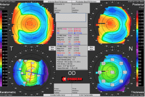 Opération de l'hypermétropie - Dr Marc Weiser - chirurgie réfractive Paris